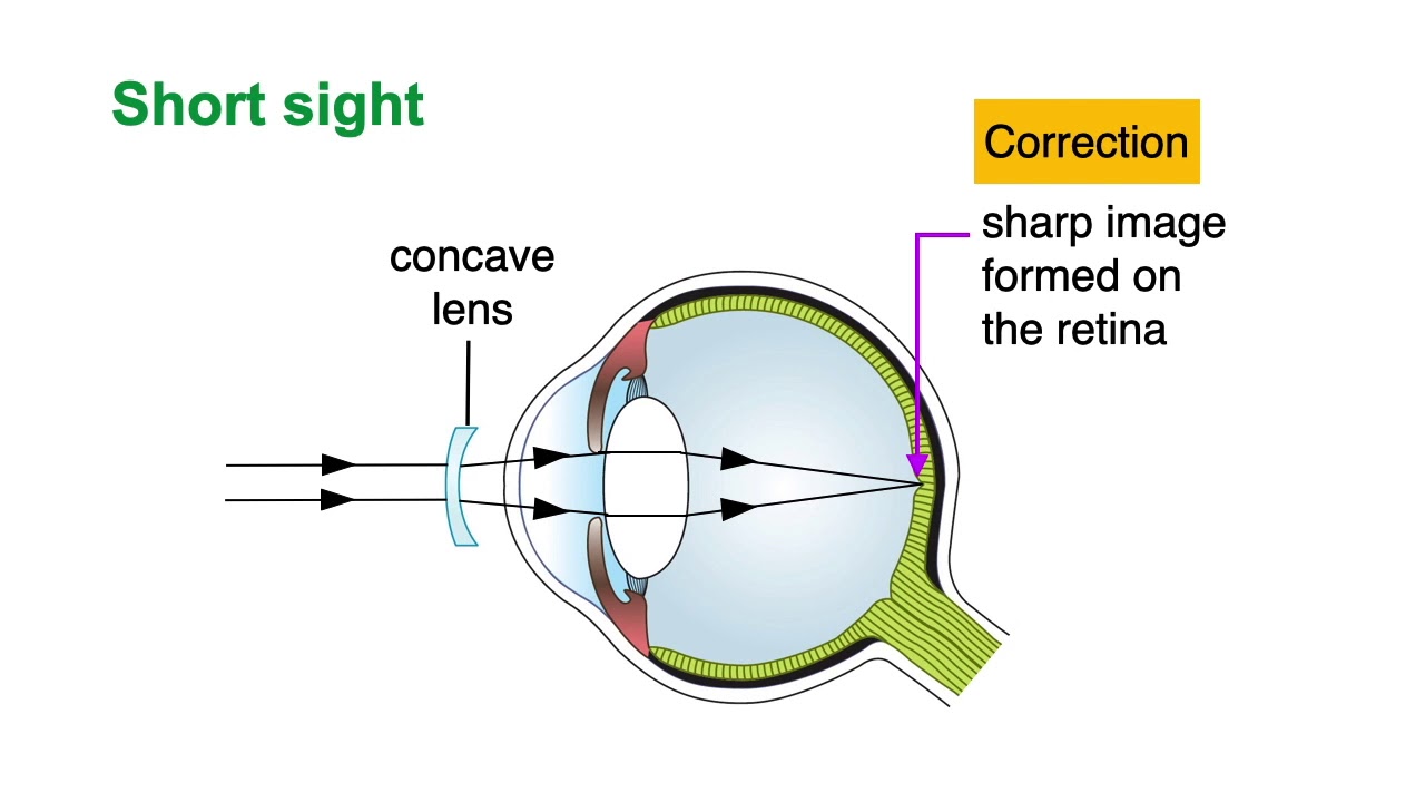 【New Mastering Science】Unit 10 | Short sight & long sight - YouTube