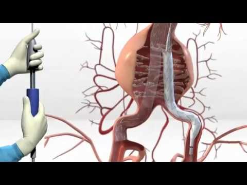 Simulacion Stent Endurant AAA de Medtronic - YouTube
