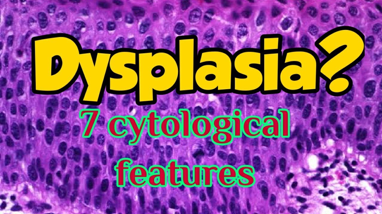 7cytological features of Dysplasia: Medschool Microvlog 8 - YouTube