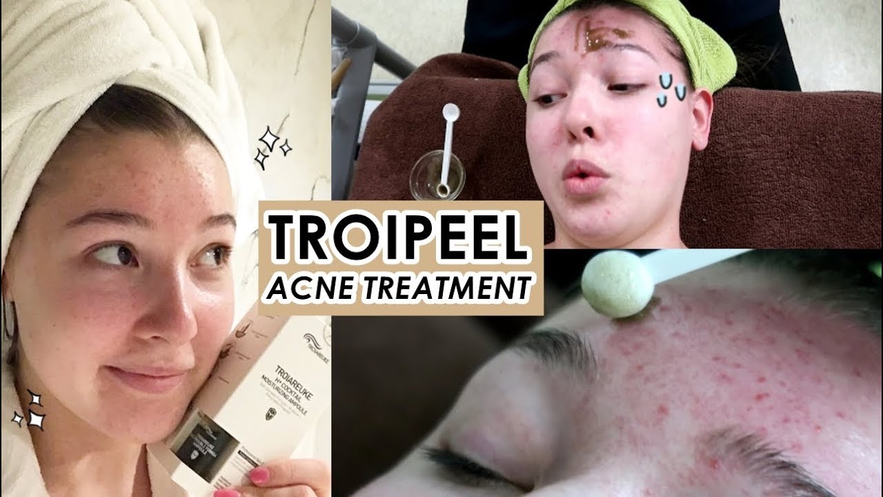 Suffering for Beauty Part 2: Troipeel Acne Treatment 😱 - YouTube