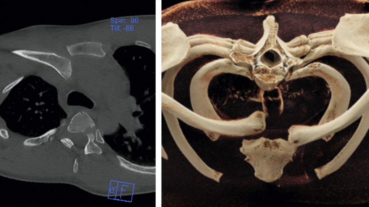 Luxation sterno claviculaire postérieure aigue / Acute posterior ...
