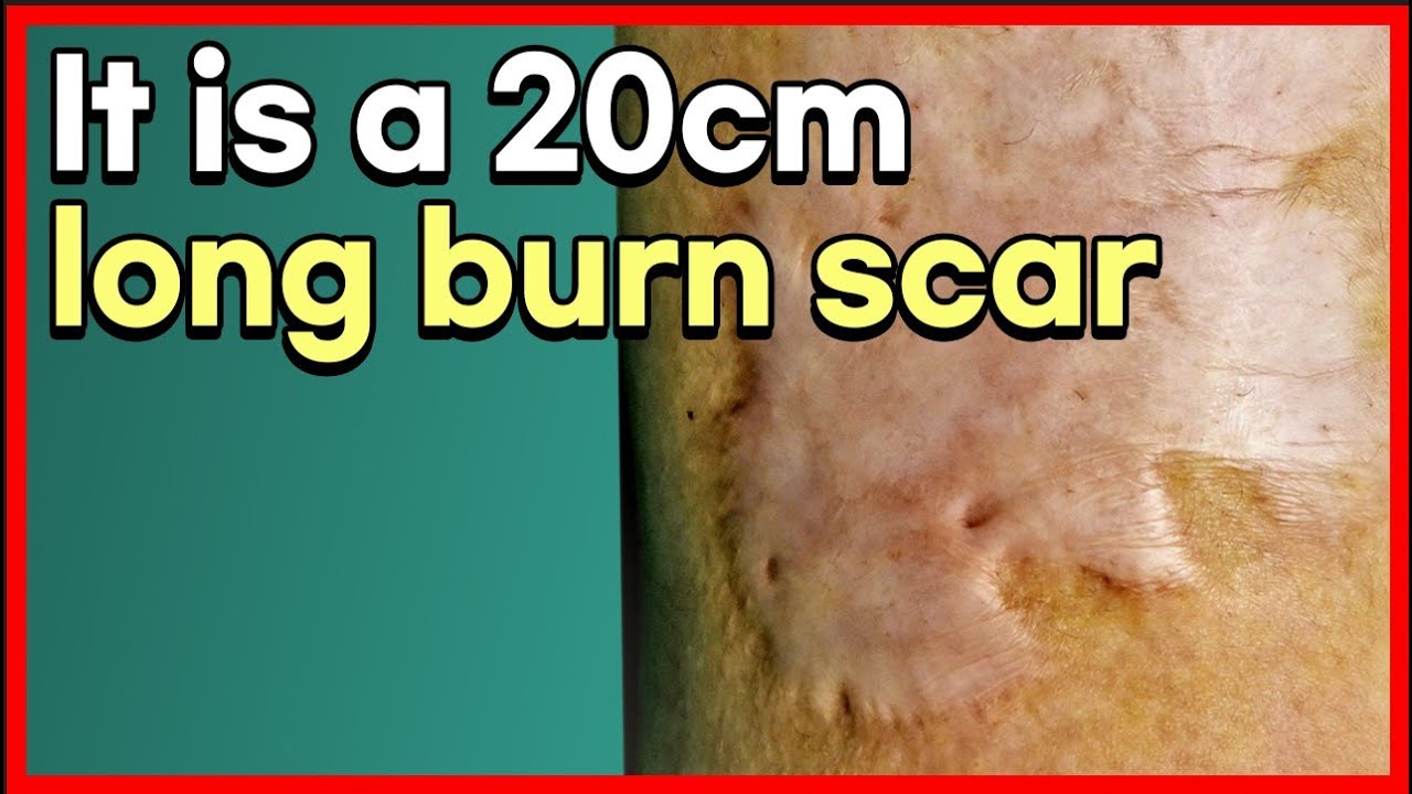 This person was burned by hot water 25 years ago. - YouTube