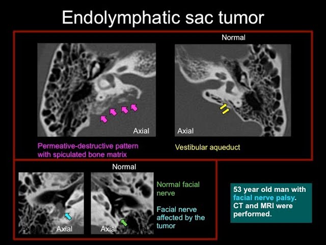 Endolymphatic Duct Endolymphatic Sac Tumor ; Definition, Causes,