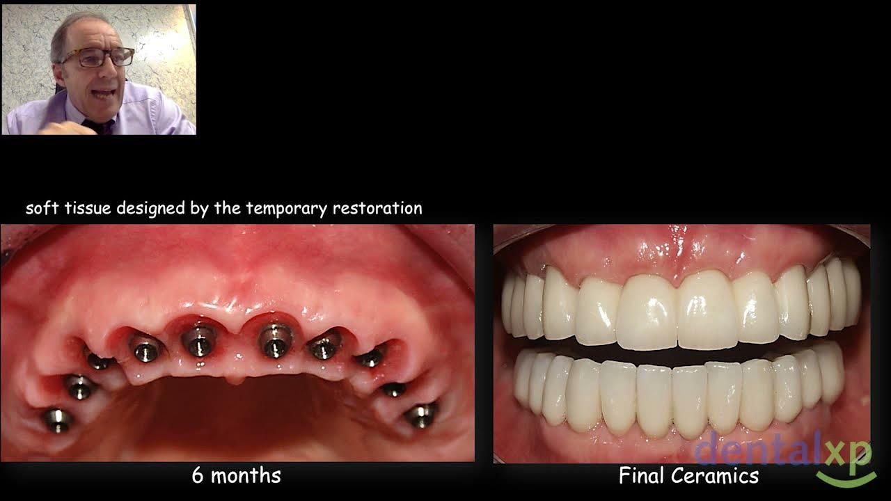 Modern Approach of Full Arch Immediate Loading - YouTube