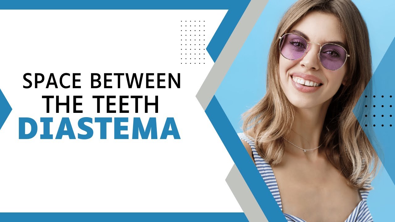 Space Between the Teeth (Diastema) - Causes, Treatment, and ...