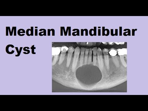 Median Mandibular Cyst - YouTube