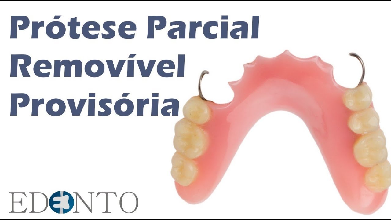 PPR provisória, prótese parcial removível provisória - YouTube