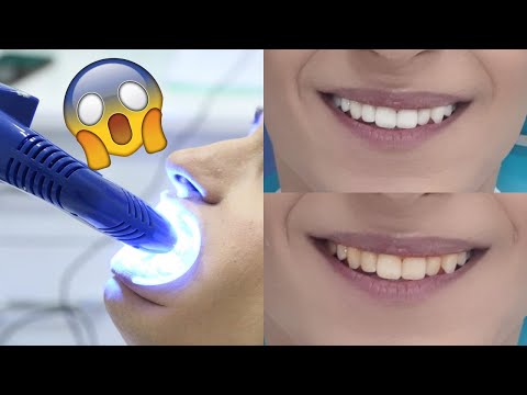 LAZER DİŞ BEYAZLATMA YAPTIRDIM (BLEACHING) - MERKÜR CAN