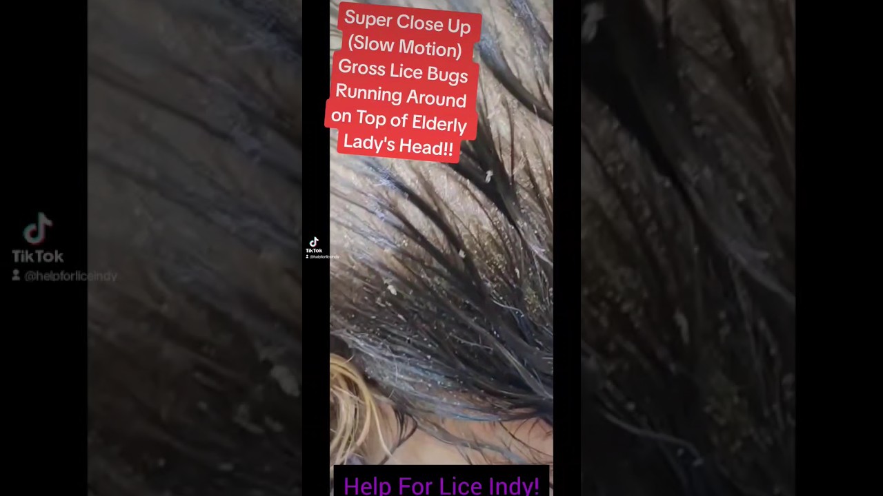 Super Closeup! Lice Infestation! Bugs Crawling on Top of Elderly Lady's ...
