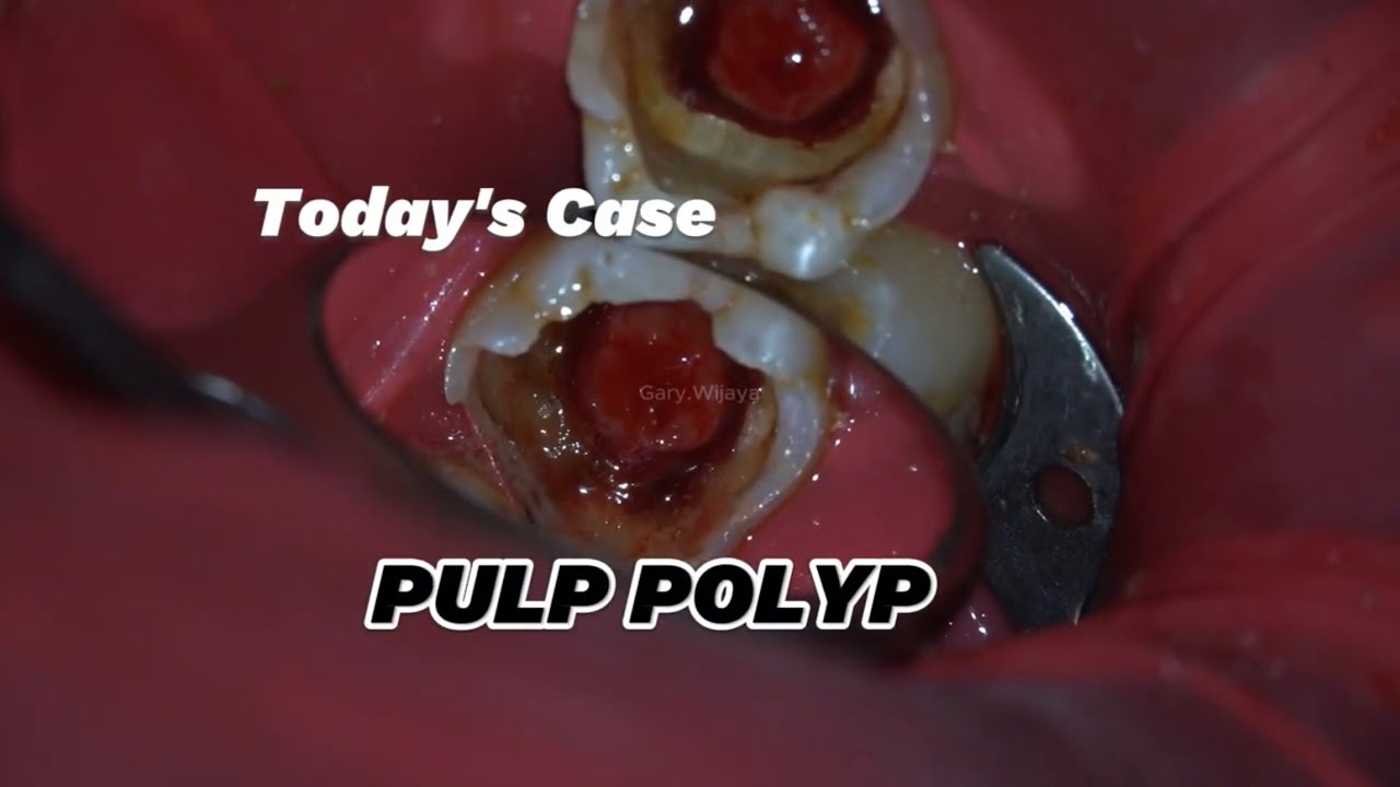 Today's Case: Pulp Polyp - YouTube