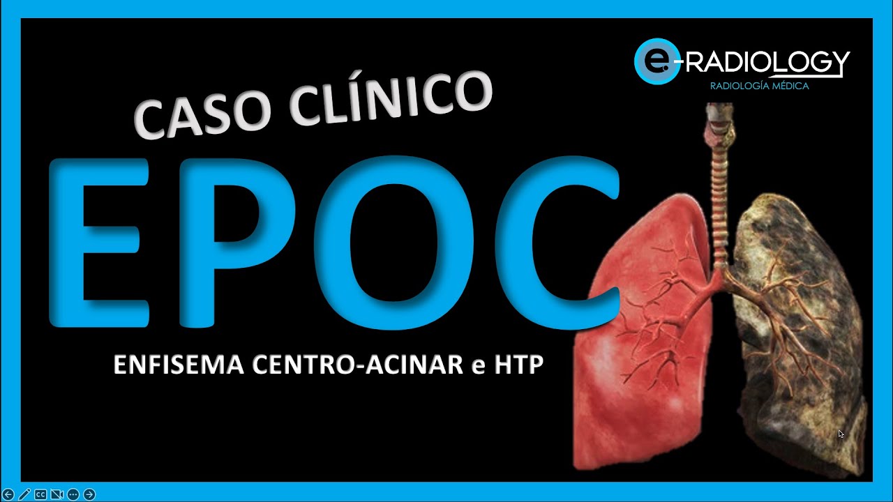 EPOC 🫁 | ENFISEMA pulmonar CENTROACINAR | Caso CLINICO 🧑🏻‍⚕️ - YouTube