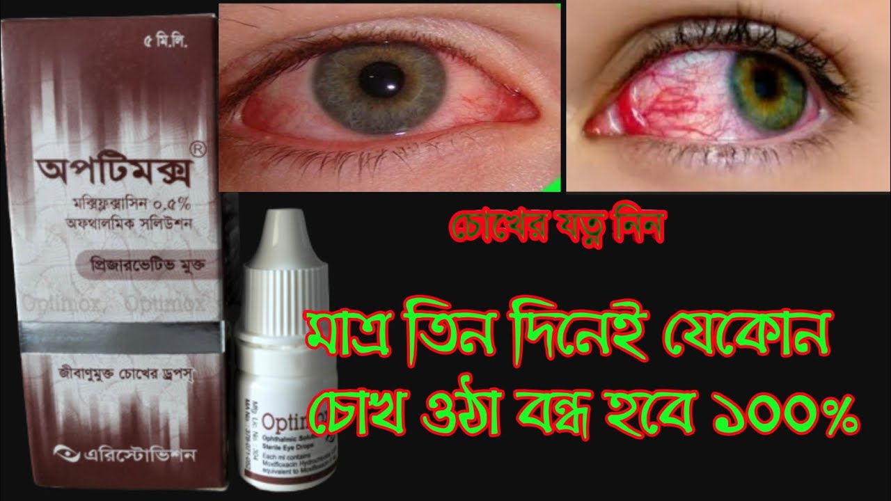 মাত্র তিন দিনেই যেকোন চোখ ওঠা বন্ধ হবে |অপটিমক্স চোখের ড্রপ | Optimox ...