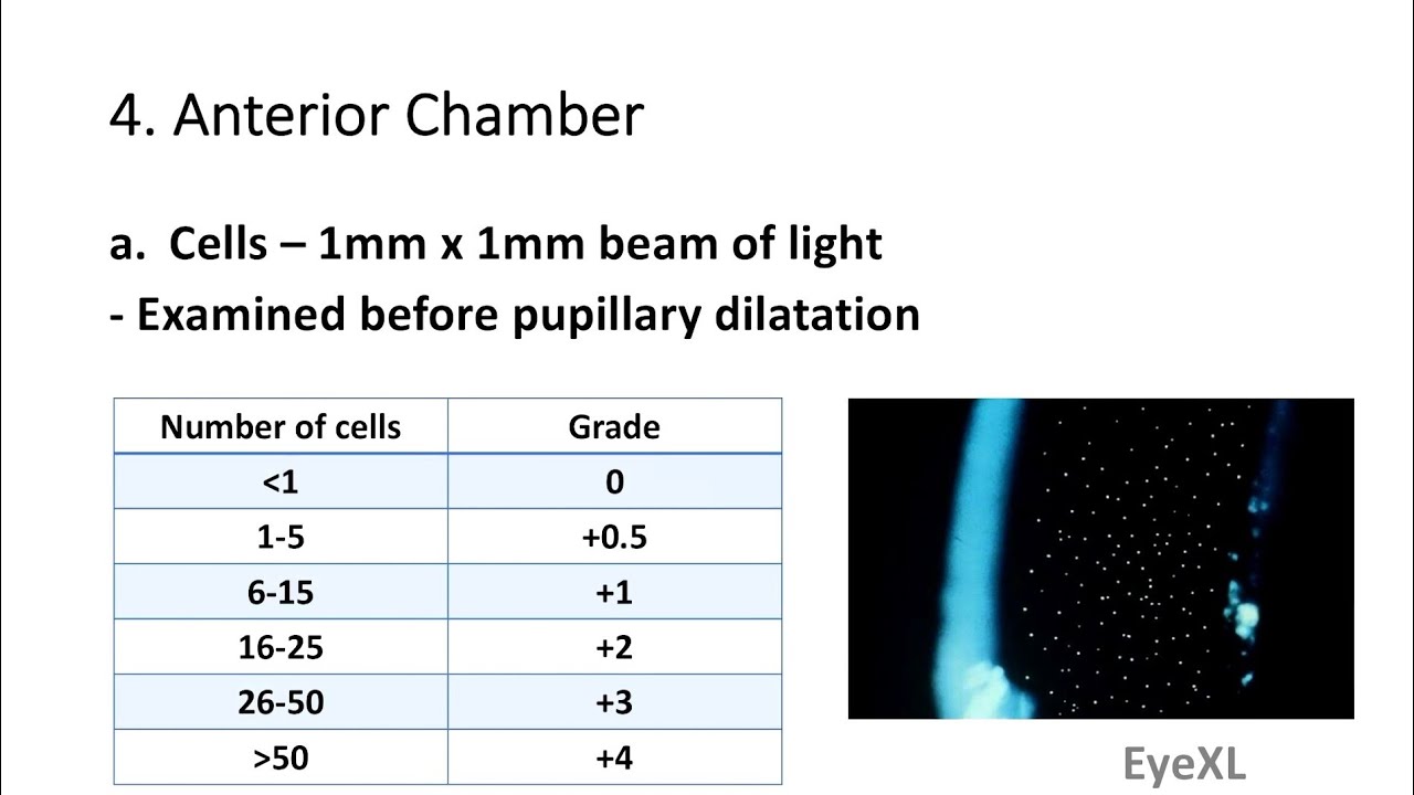 Acute Anterior Uveitis - Clinical Features & Management - YouTube
