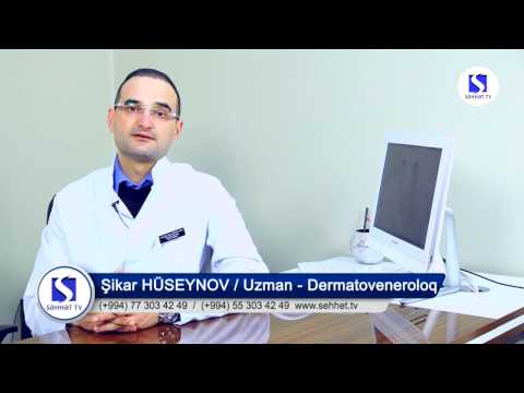 Sizanaqlar necə müalicə olur // Uzm. Dr. Şikar Hüseynov