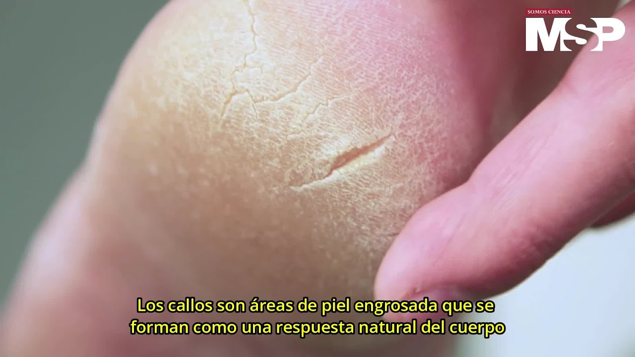 ¿Cómo funcionan los callos? - #ExclusivoMSP - YouTube