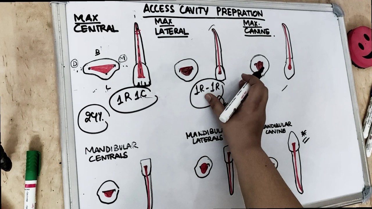 access cavity preparation - anterior teeth - YouTube