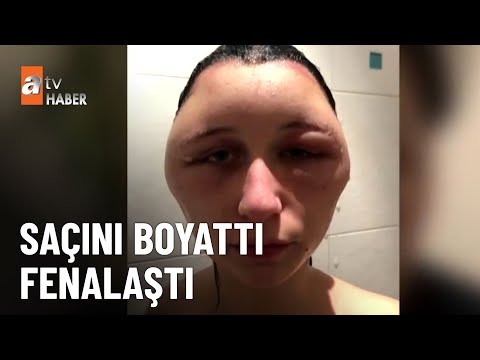 Saç boyası alerjisine dikkat! - atv Ana Haber 13 Ekim 2025