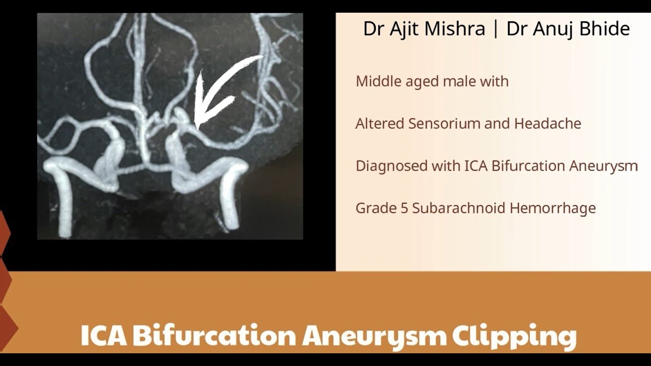 Brain Aneurysm Clipping | Carotid Artery Aneurysm Clipping | ICA ...
