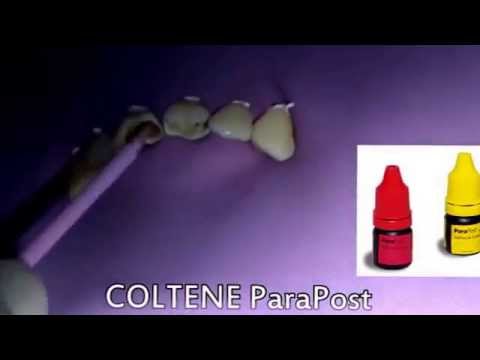 Dr. Daniel Gustavo Martucci, Argentina, Caso clinico con Postes de ...