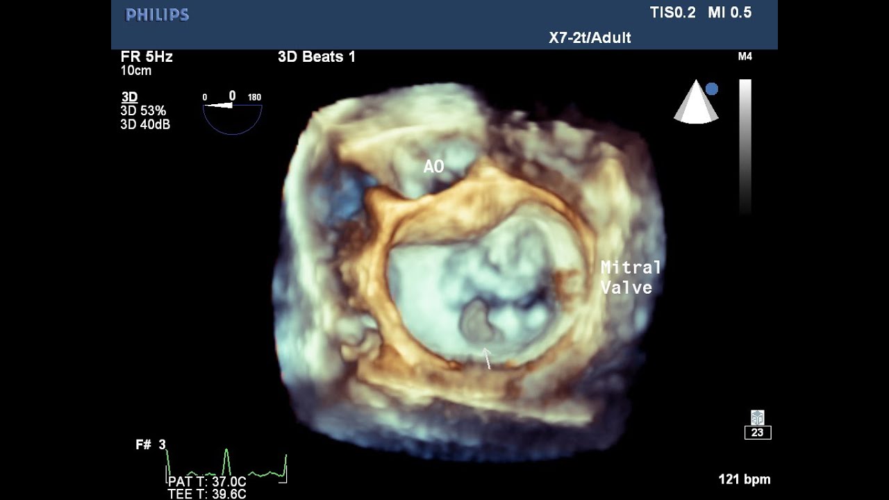 Libman Sacks endocarditis-Antiphospholipid syndrome - YouTube
