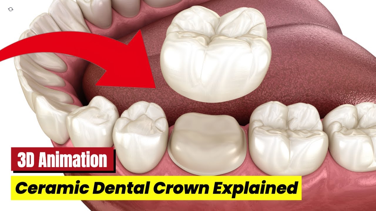 Ceramic Dental Crown Explained 3D Animation of Tooth Restoration & Care ...