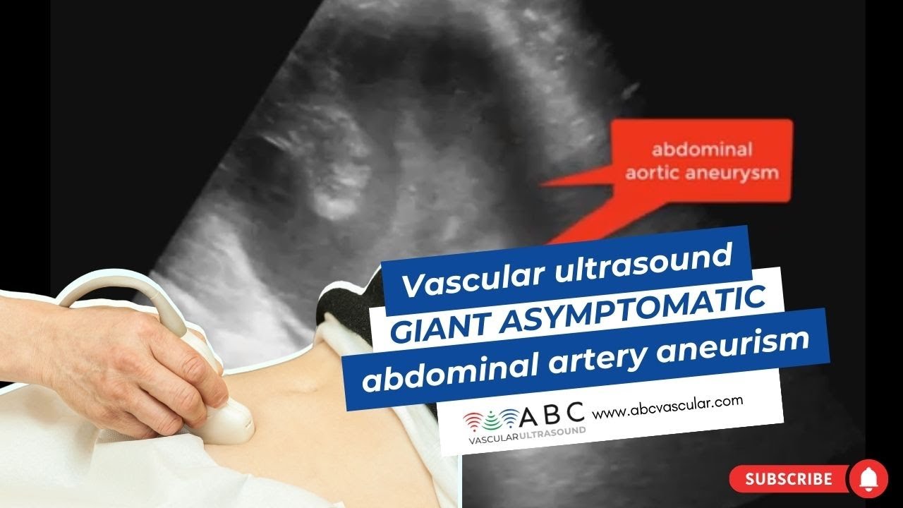 VASCULAR ULTRASOUND: Giant asymptomatic AAA (b-mode) - YouTube