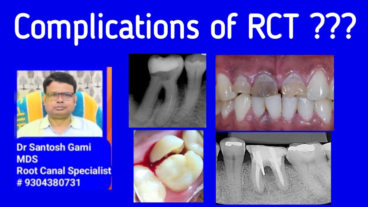 Complications of RCT ??? RCT करवाने से क्या- क्या दिक्कत होता है। - YouTube