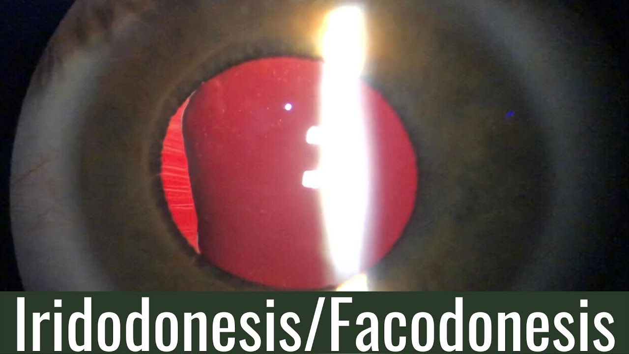 Iridodonesis