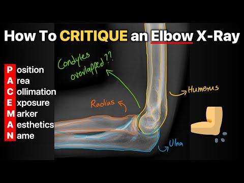 How To Critique an Elbow X Ray!