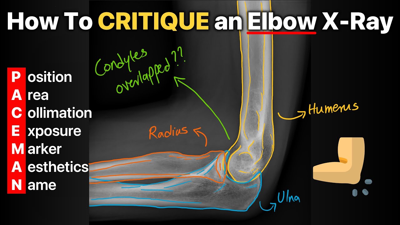 How To Critique an Elbow X Ray! - YouTube