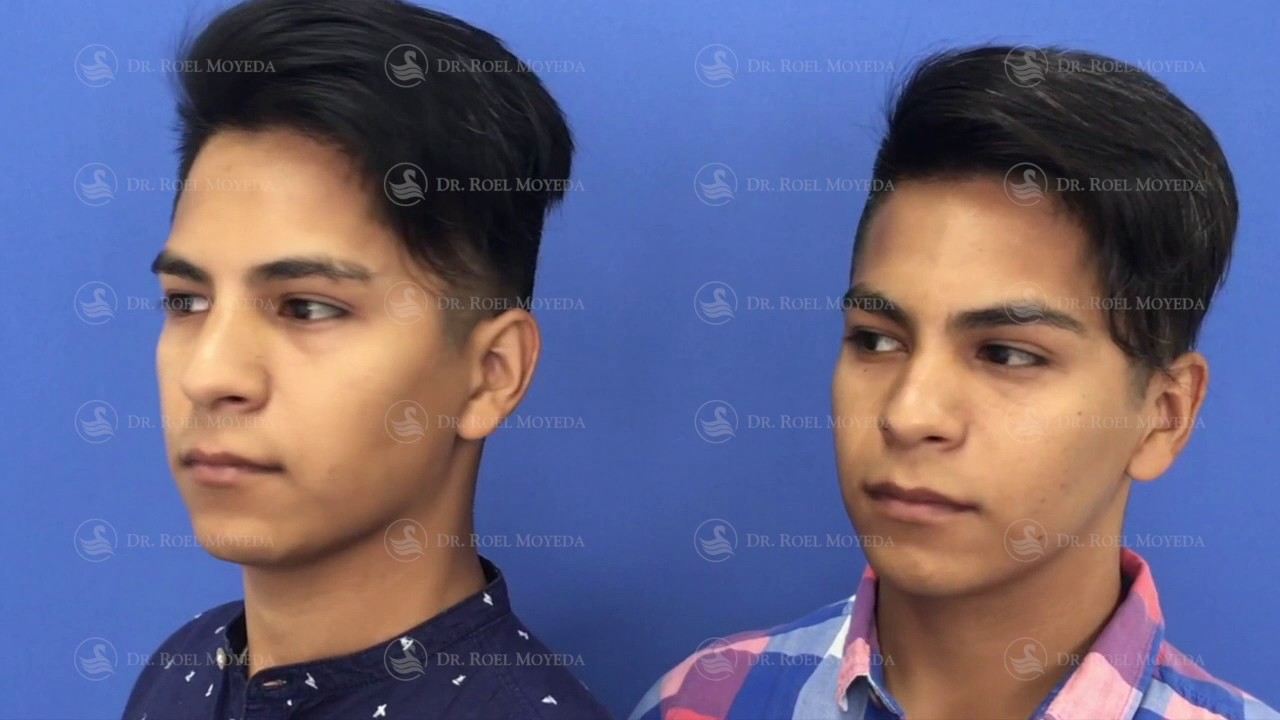 Cirugía Plástica en Gemelos - YouTube