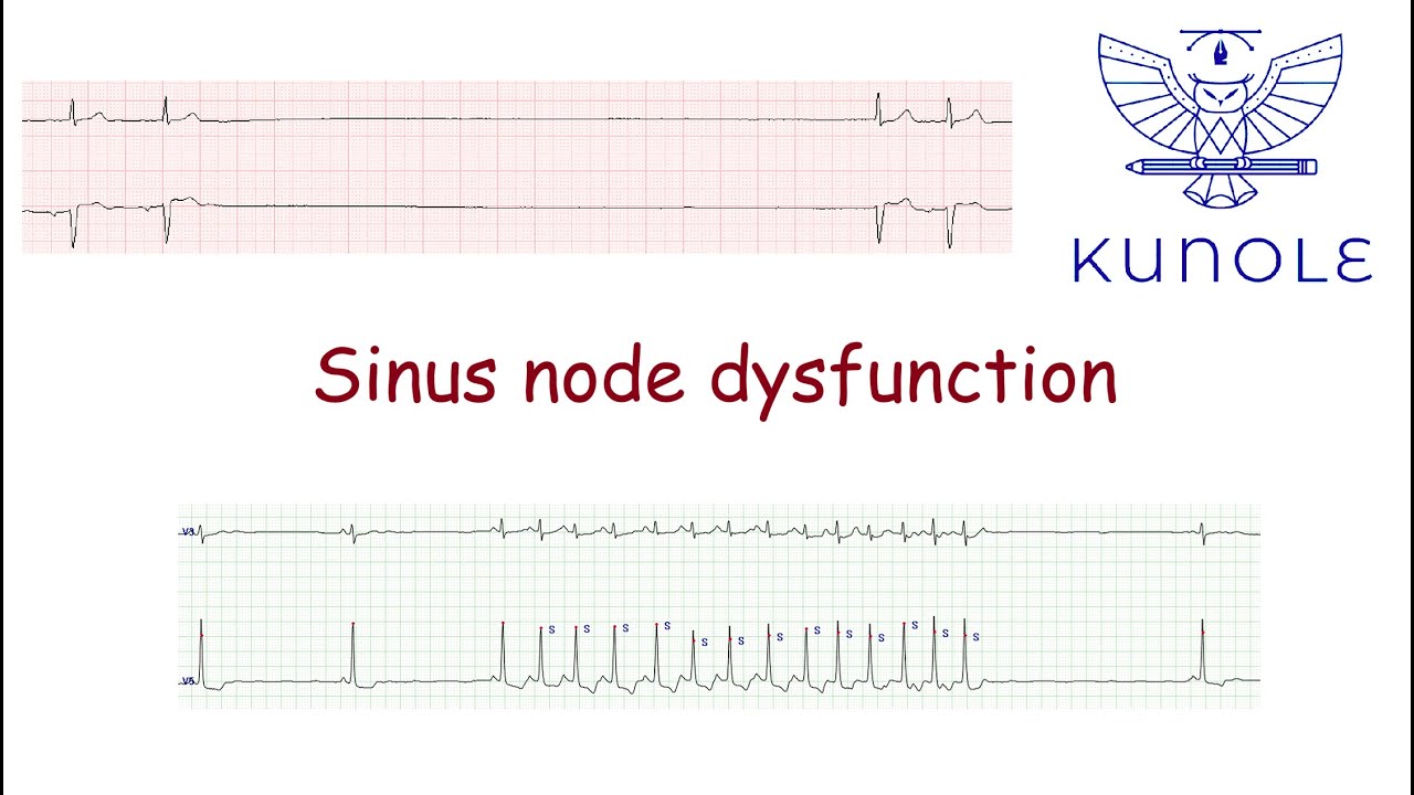 Bradycardias and conduction disorders (3.2). Sinus node dysfunction ...