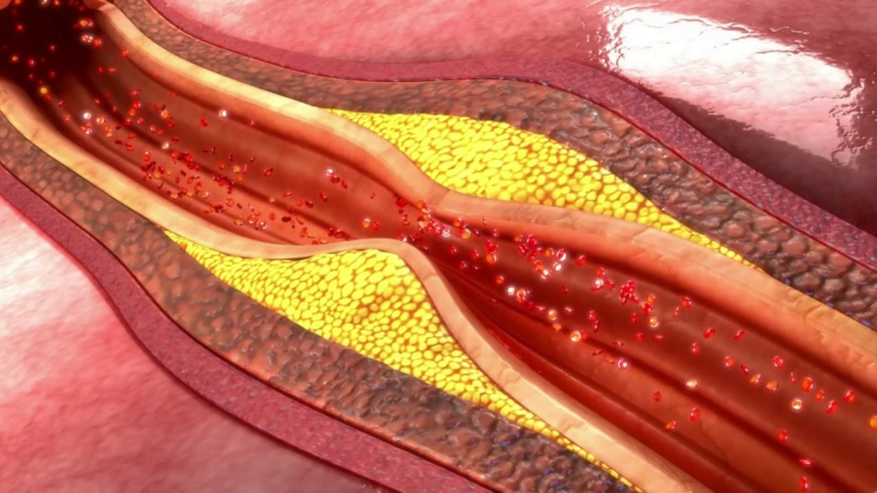 Alteraciones del Sistema Circulatorio - YouTube