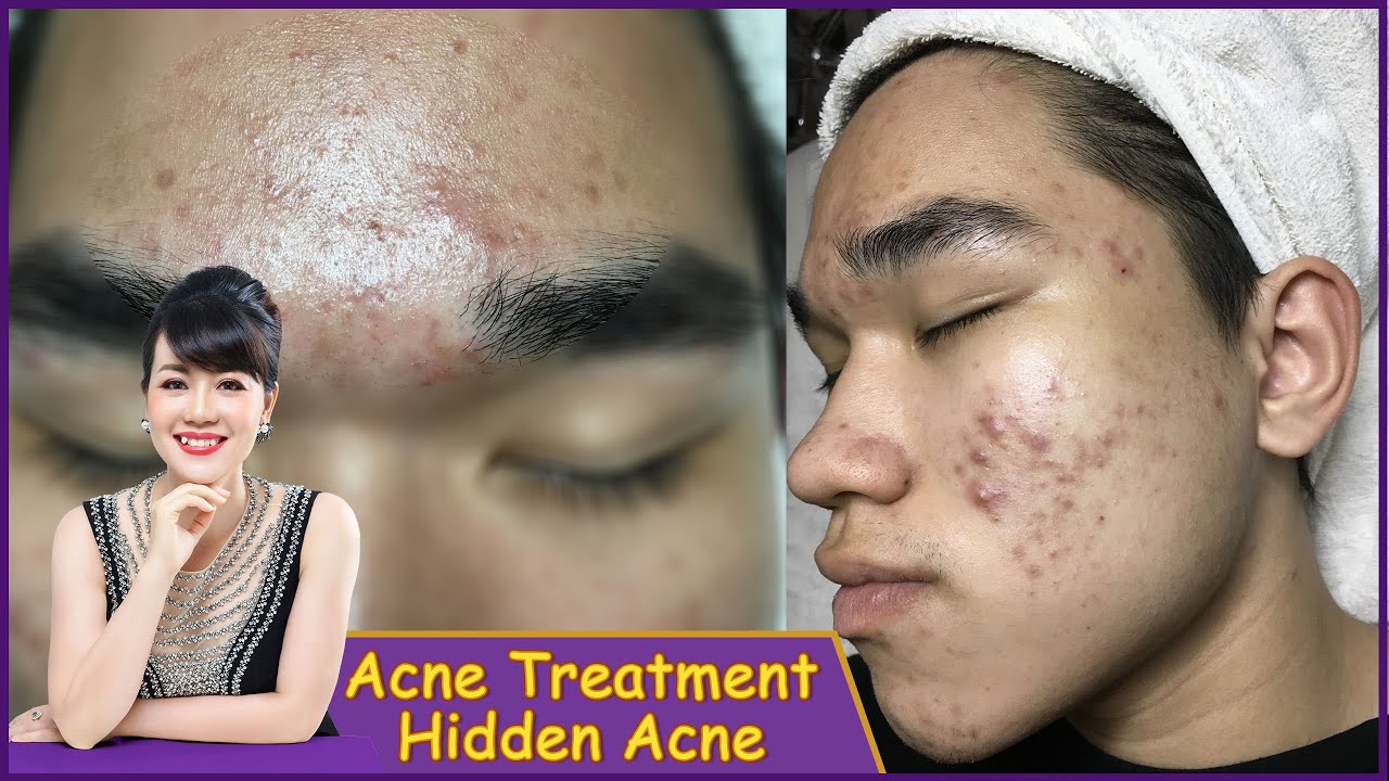 Acne Treatment | Điều trị mụn hiệu quả số 1 TPHCM | Hiền Vân Spa |Mụn ...
