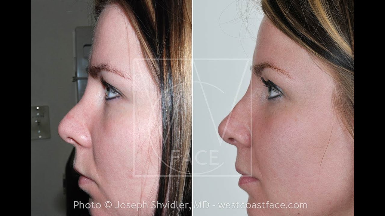Rhinoplasty Surgery in Seattle WA | Joseph Shvidler, MD - YouTube