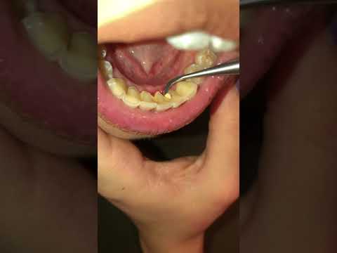 Plaque Removal! Satisfying chunk! - YouTube
