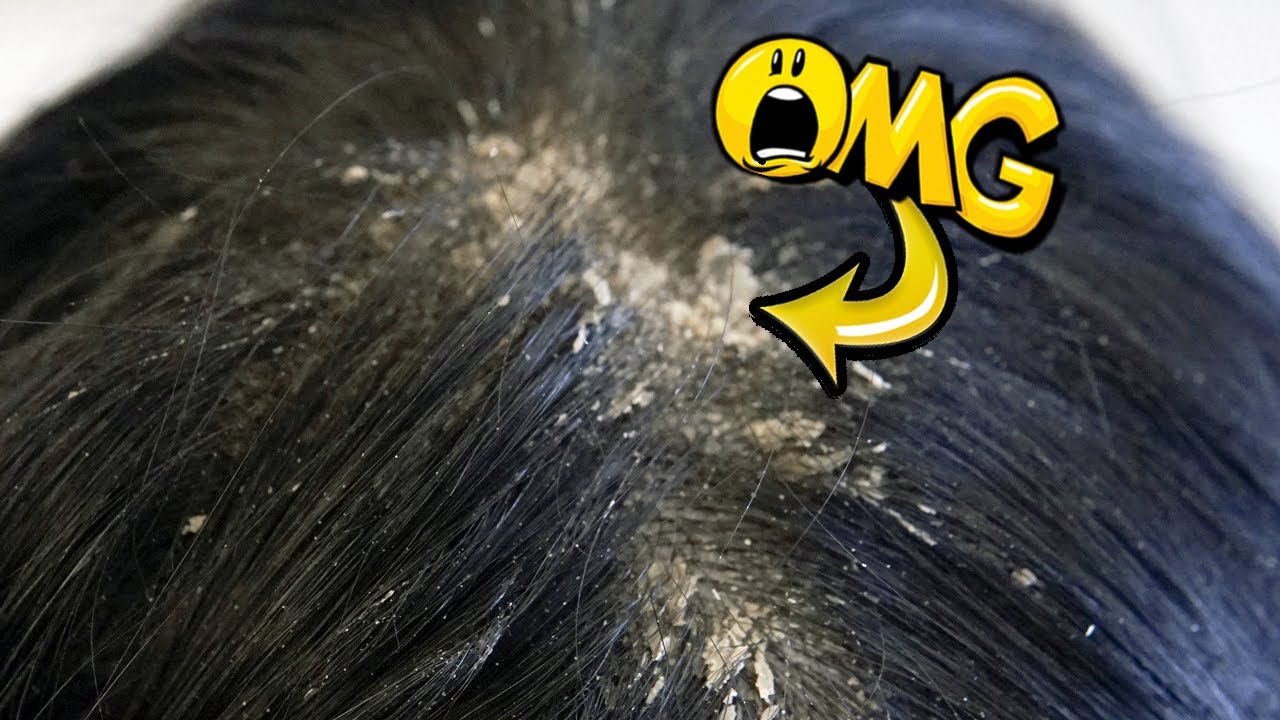 How to cure Dandruff Scratching at home - How to remove dandruff on my ...