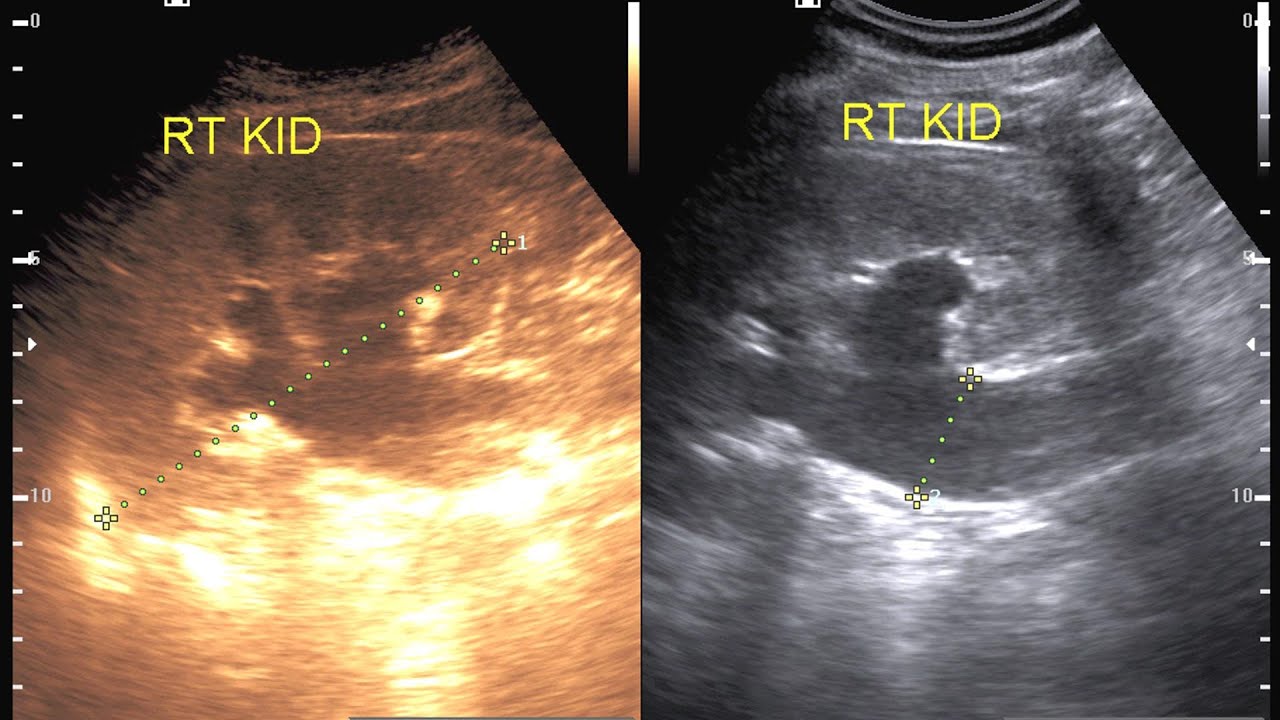 Ultrasound cases 283 of 2000 || Moderate Hydro nephrosis Right Kidney ...