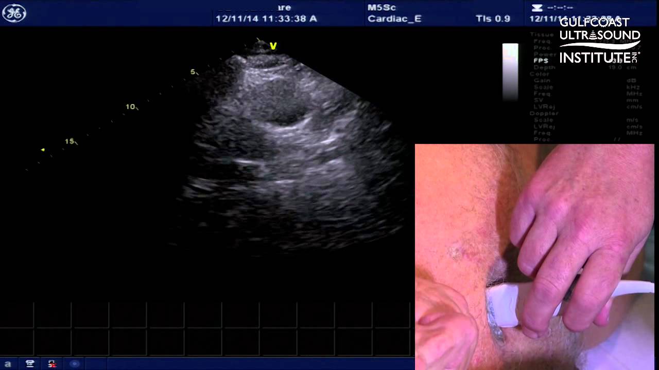 Hot Tips - Obtaining a Right Parasternal Cardiac Window - YouTube