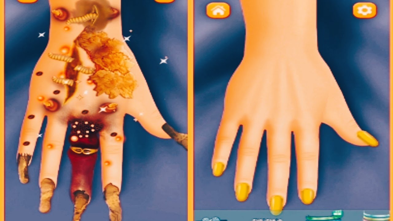 Asmr | surgery to remove large planter warts animation | nails & corn ...