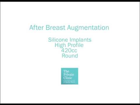 Breast Augmentation Before After, pre-post OP, Silicone Implants 420cc ...