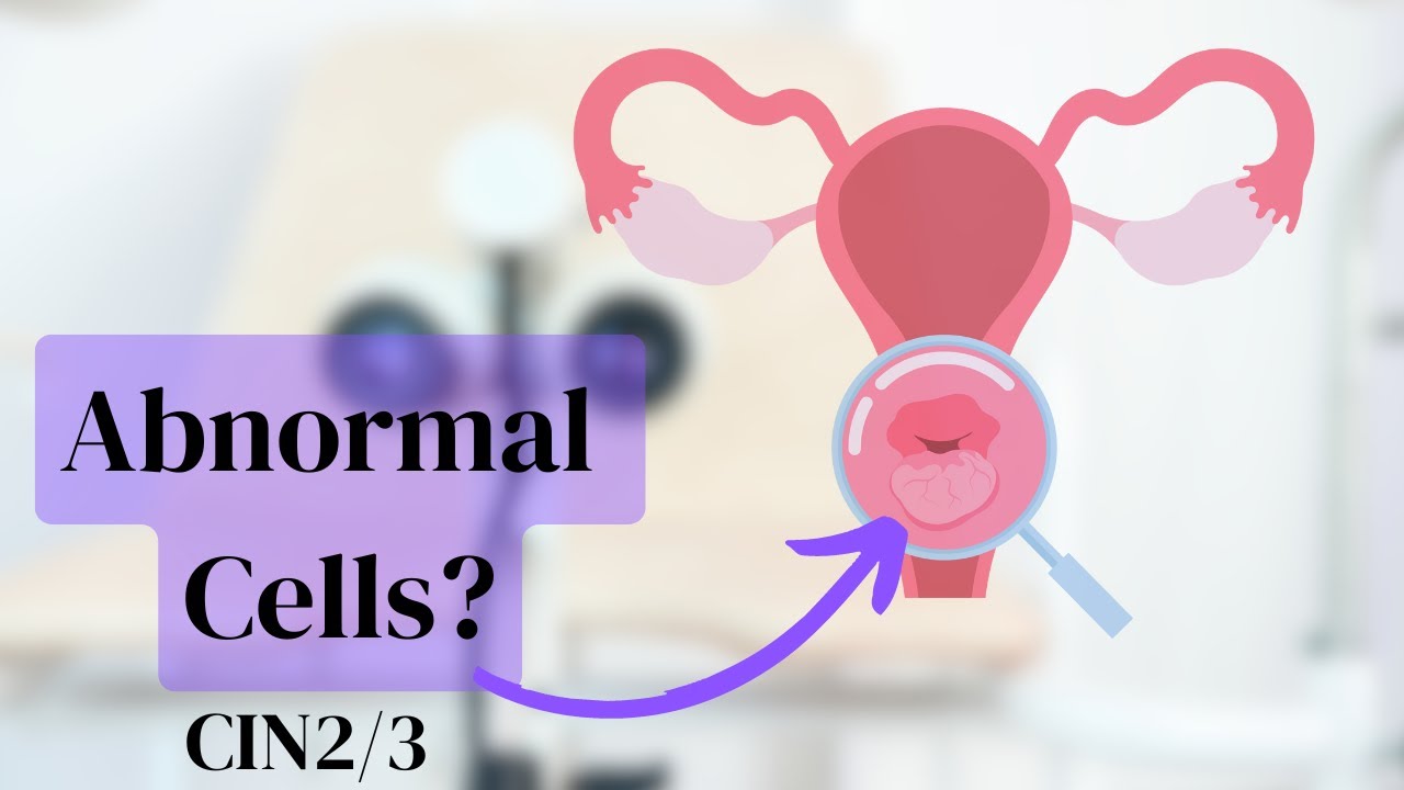 LEEP/LEETZ: Treating precancerous cells of the cervix! - YouTube