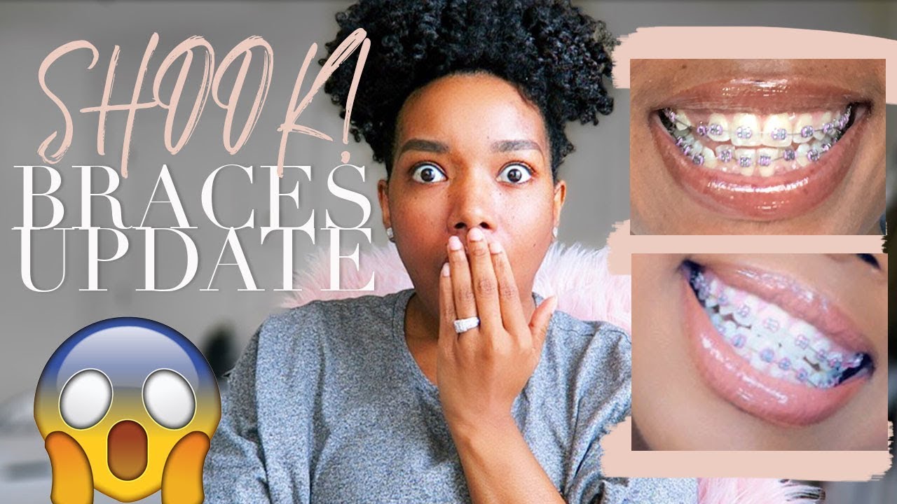 7 MONTH BRACES UPDATE!!! - YouTube