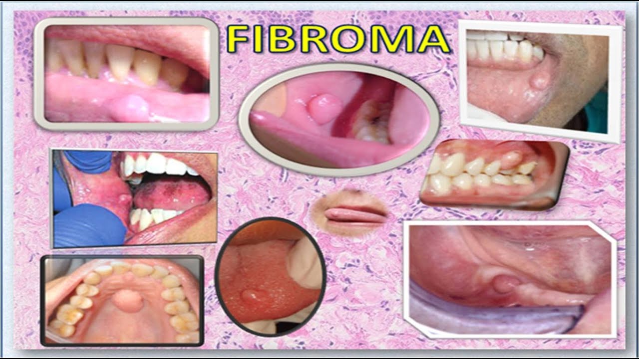 Fibroma - YouTube