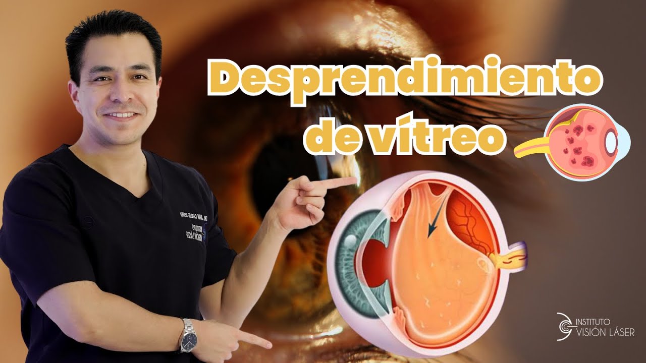 Desprendimiento de Vítreo - YouTube