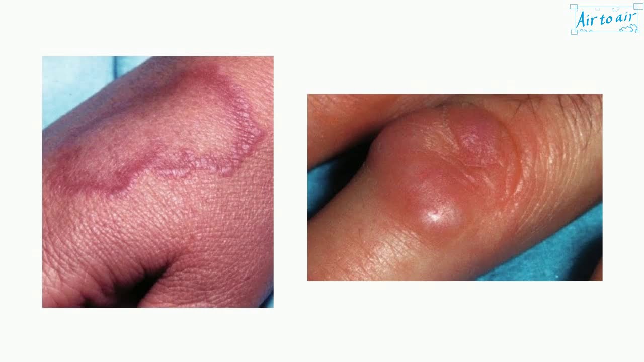 induration - YouTube