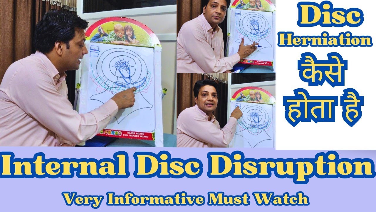 Internal Disc Disruption !! Mechanism Behind Disc Herniation !! Dr ...