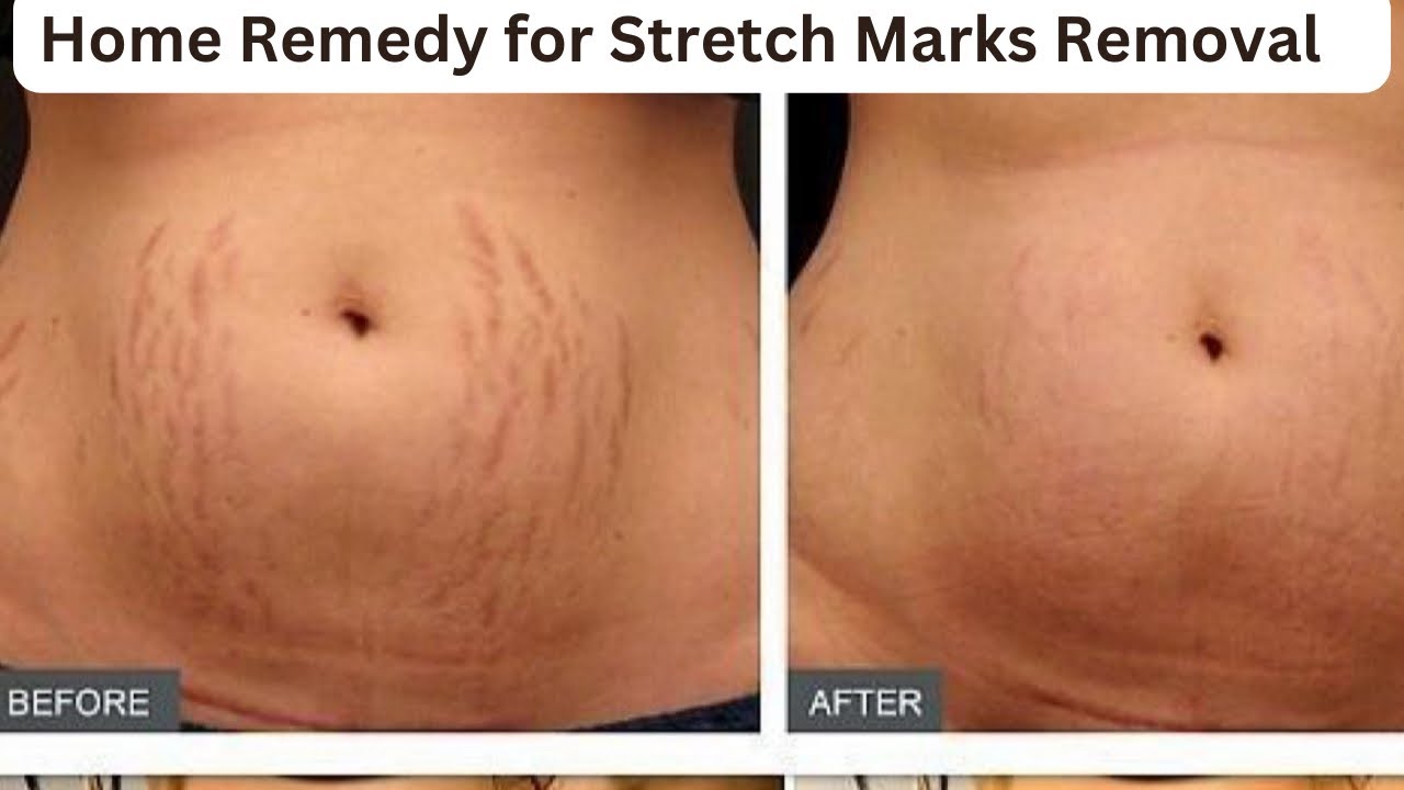 How To Remove Stretch Marks With Simple Ingredients Remove Stretch
