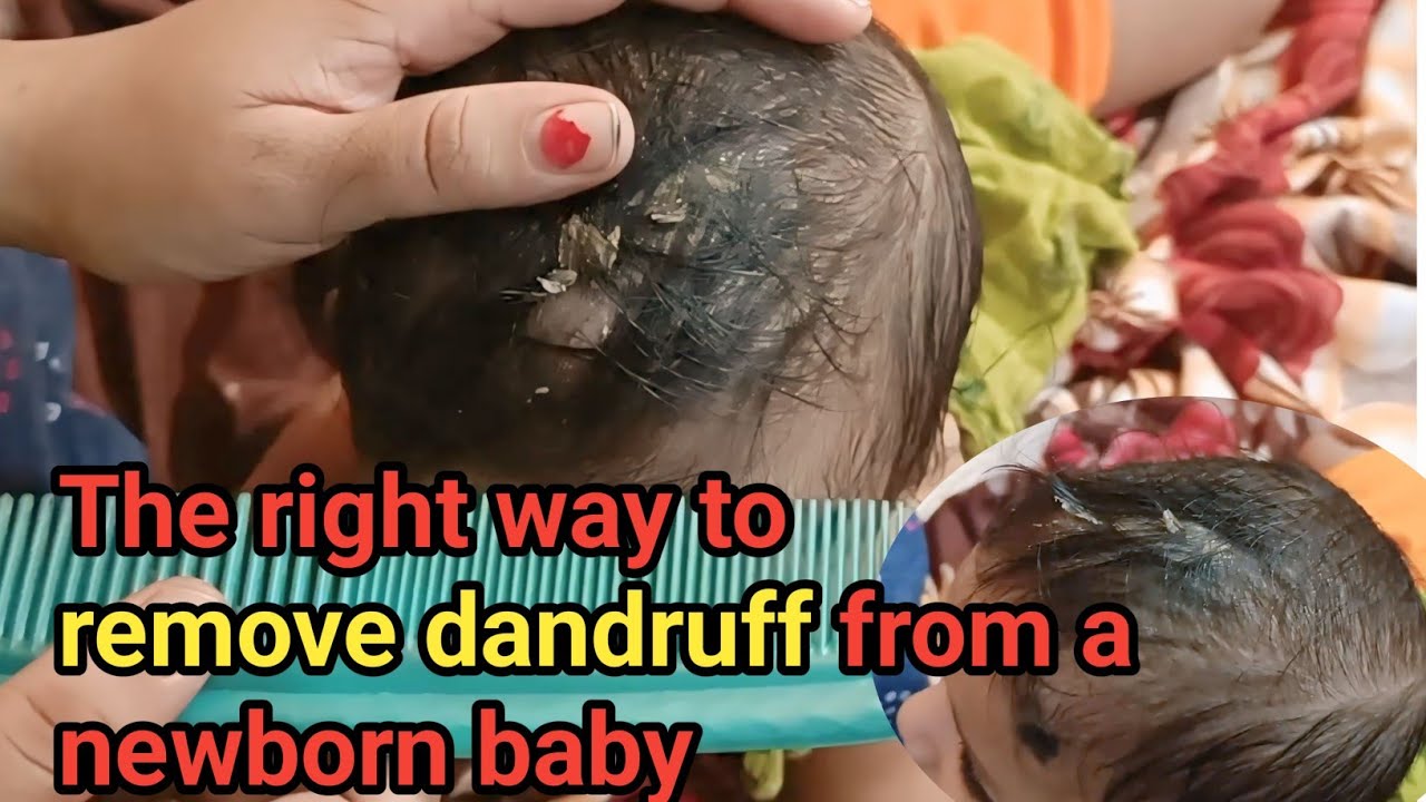 The right way to remove dandruff from a newborn baby || आसानी से हटाए ...
