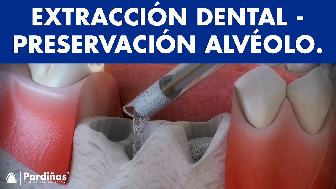 Extracciones dentales - Tratamiento de preservación alveolar © - YouTube